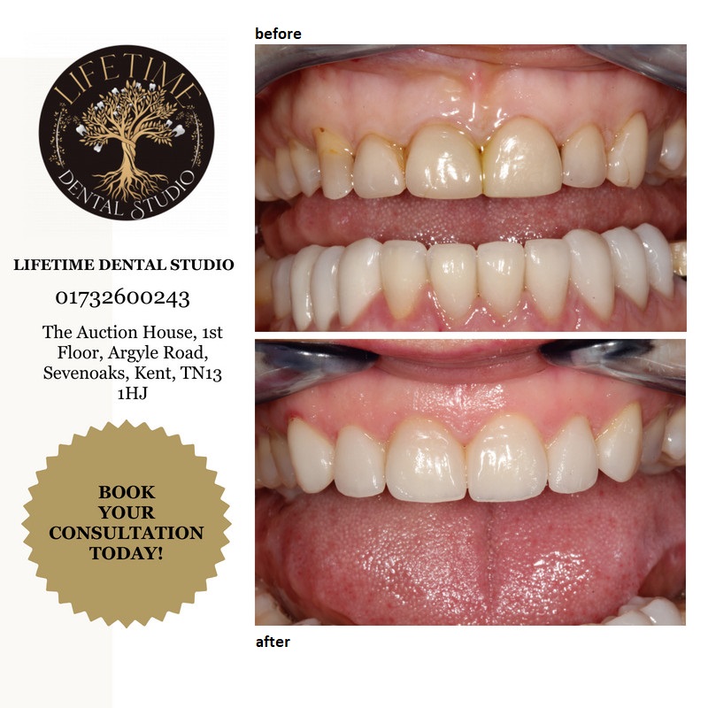 Smile Gallery - Lifietime Dental Studio | Sevenoaks